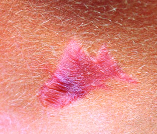 Schwere Zeiten für Keloide und hypertrophe Narben, MenkeMED GmbH, Story ...